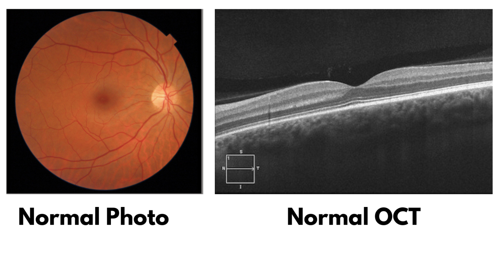 Why Get Wellness Photos (Retinal Photo and OCT)? | theeyeshopaz.com